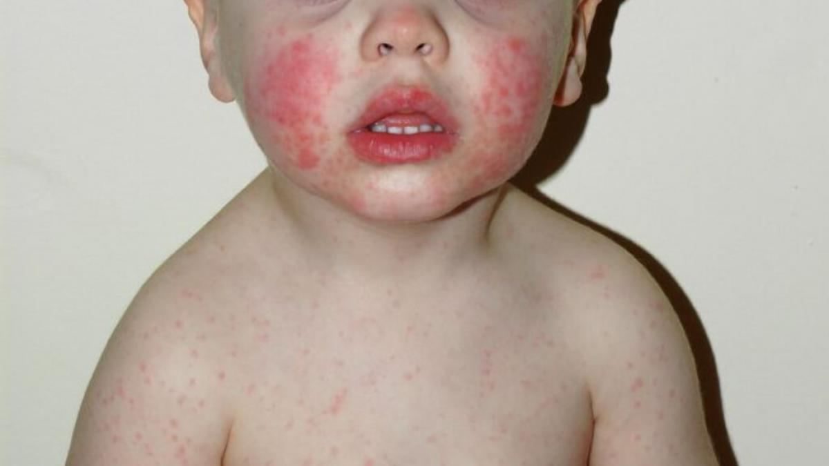 Aumenta el parvovirus B19 en Europa: qué es y quiénes son los vulnerables